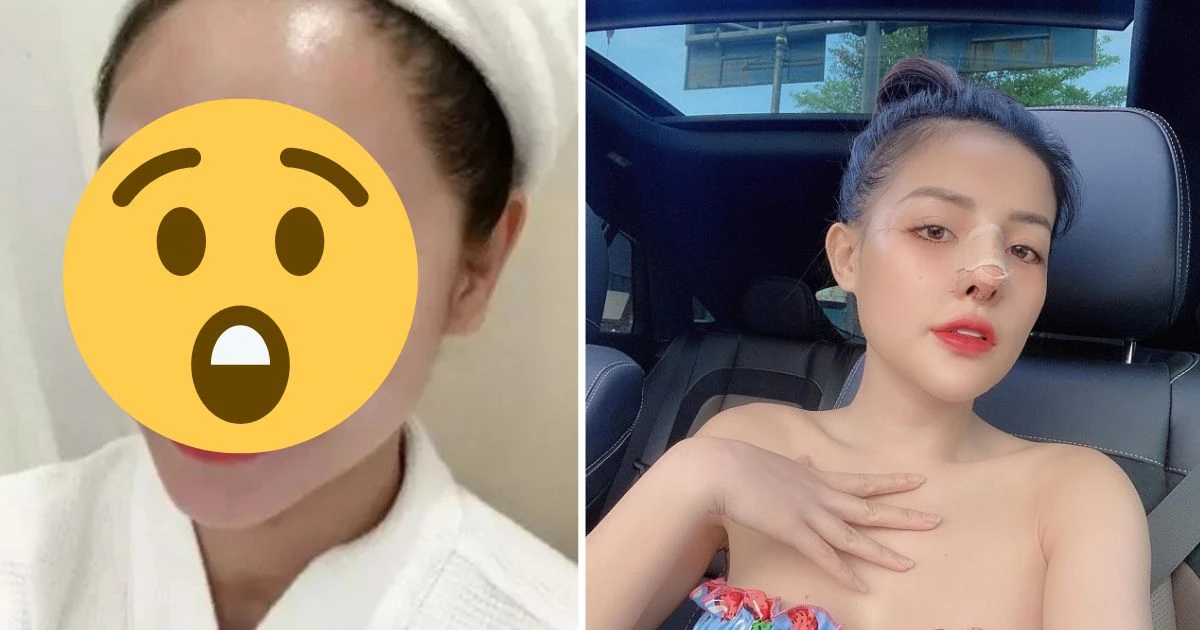 Tuong Vi's nose was deformed due to plastic surgery, but Ngan 98 still feels luckier ...